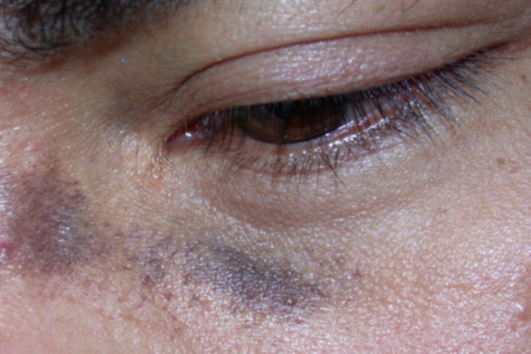 Nevus of Ota: More Than A Simple Case Of Hyperpigmentation - Angeline ...